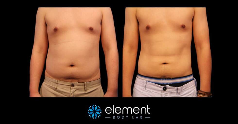 CoolSculpting for Men: The Best CoolSculpting Areas for Stubborn Fat ...