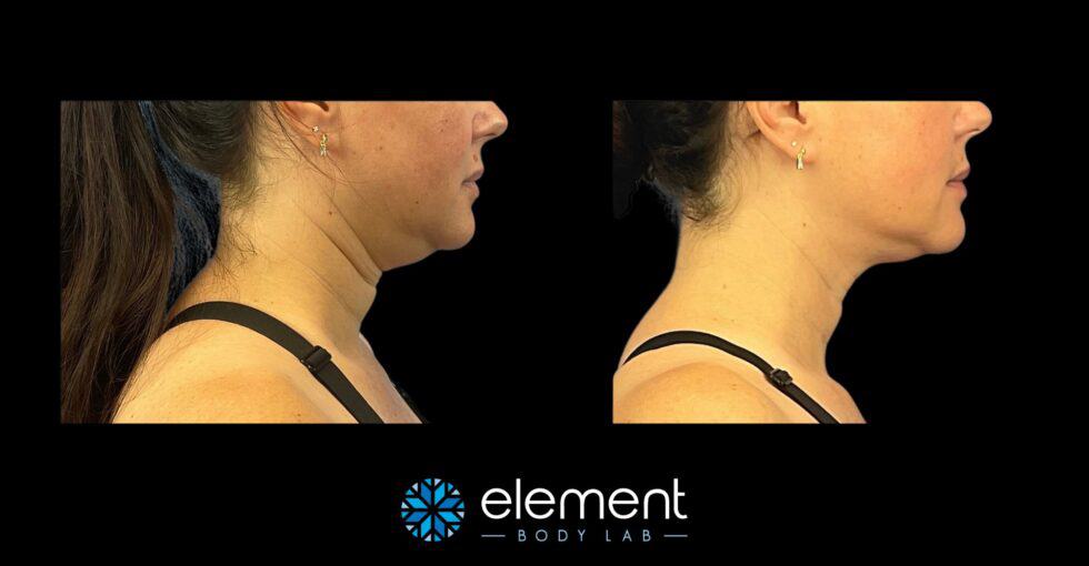 CoolSculpting Treatments: How Many Do You Need? 5 Key Factors