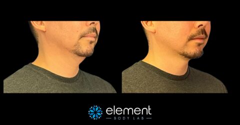 Coolsculpting for Men in Dallas, Texas | Element Body Lab
